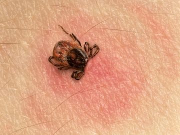 Piqûre de tique : 7 réflexes à adopter pour prévenir la maladie de Lyme