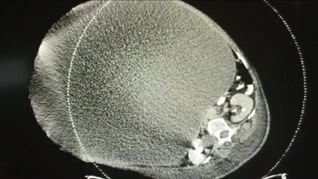 Pensant être enceinte, elle découvre la vérité sur son gros ventre