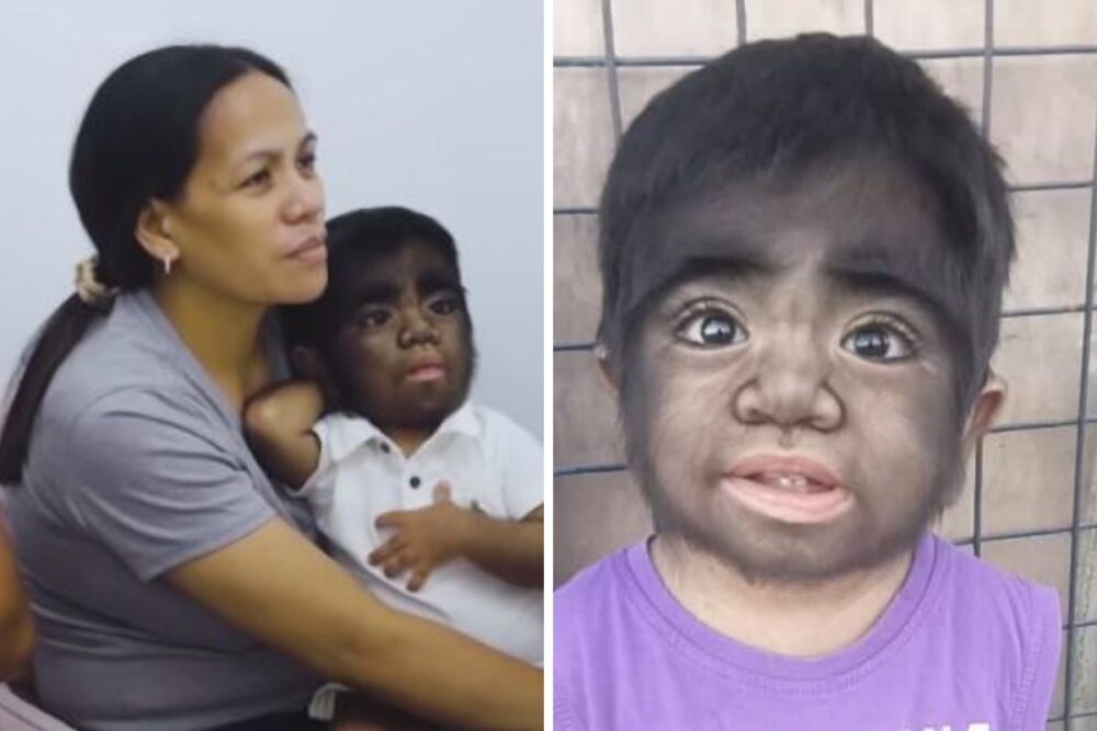 Elle mange du chat enceinte, son fils naît avec un "syndrome du loup-garou"